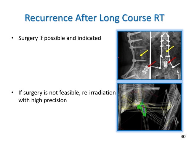 Management of malignant spinal cord compression | PPTX | Cancer ...