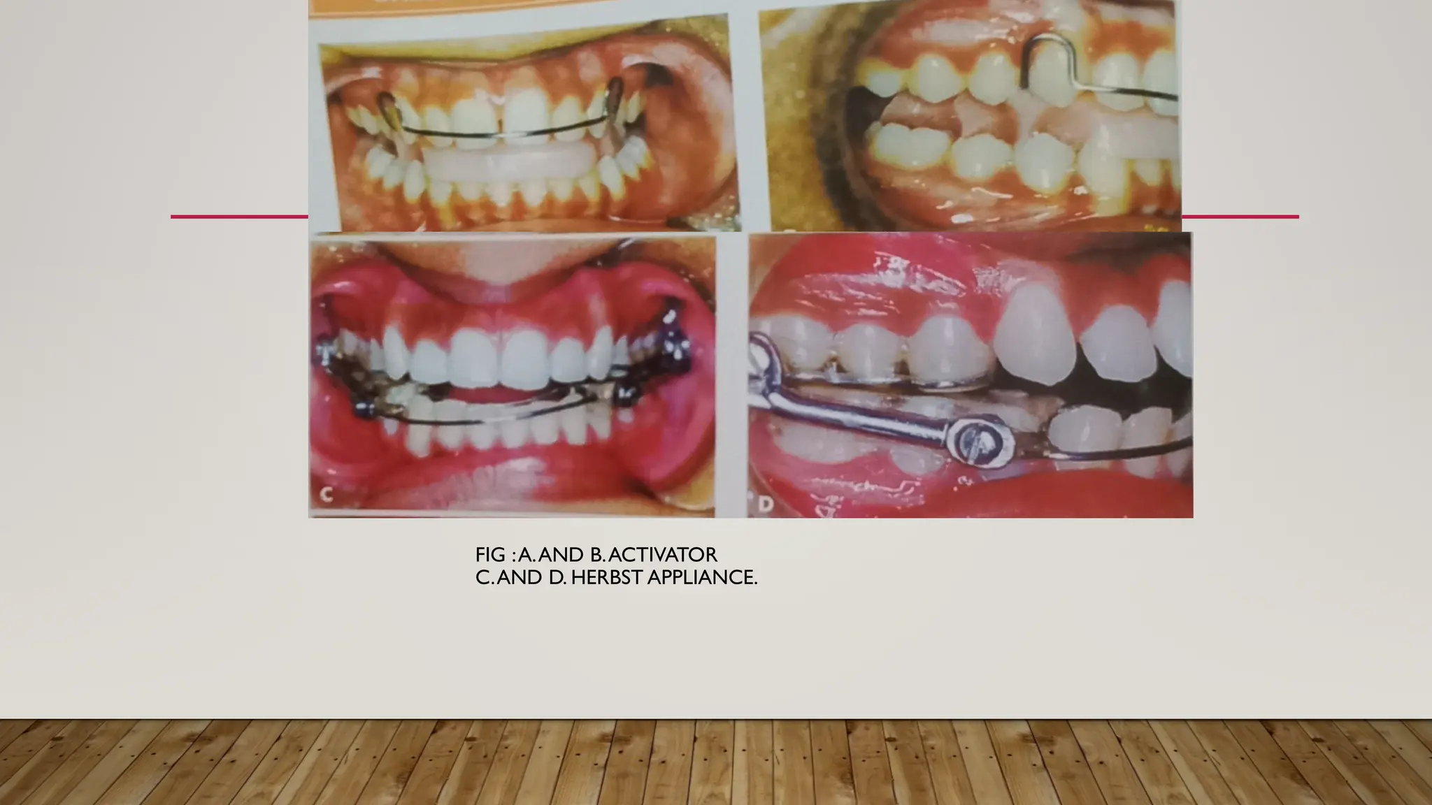 management of malocclusion in orthodontics | PPTX