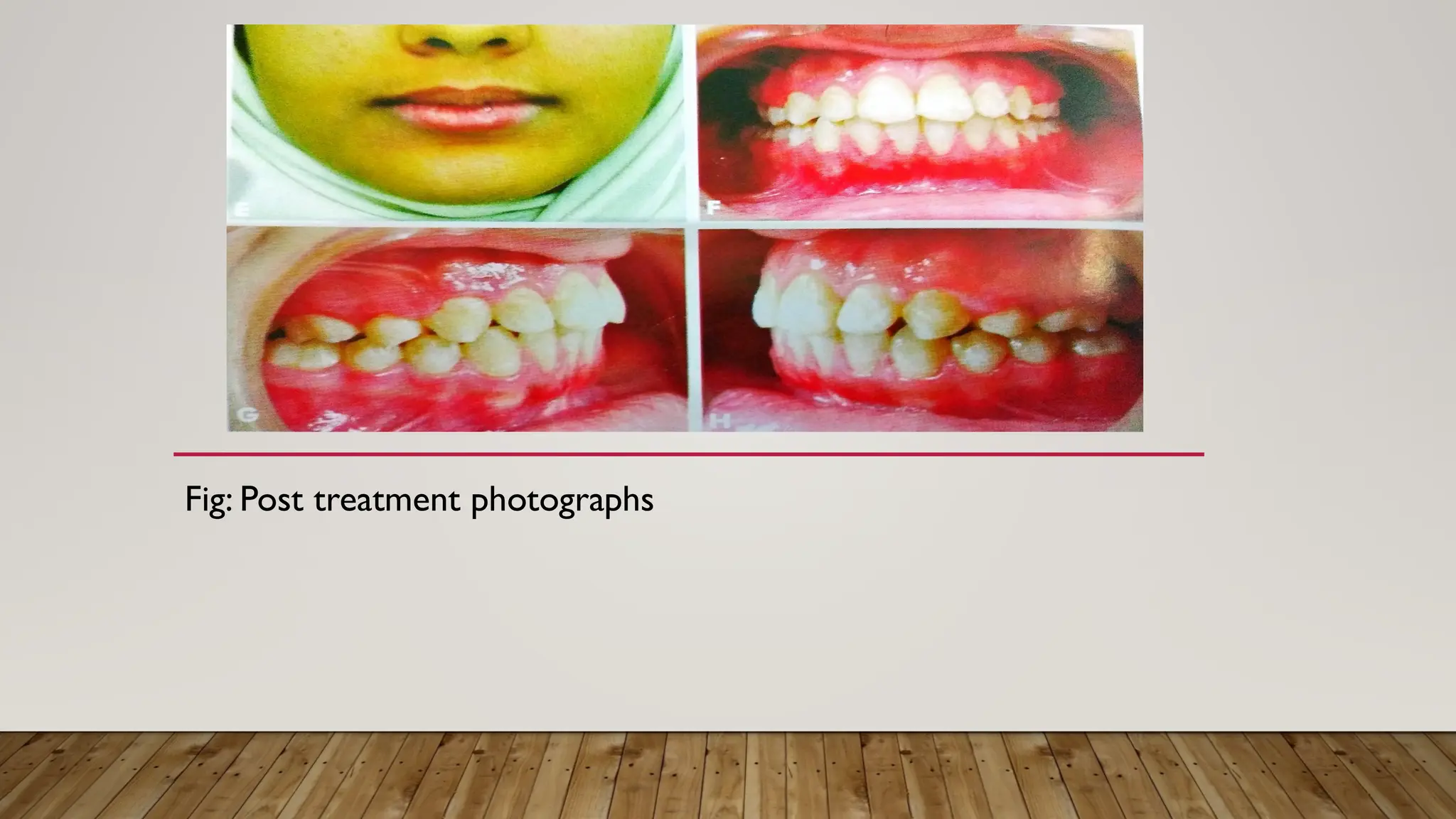management of malocclusion in orthodontics | PPTX