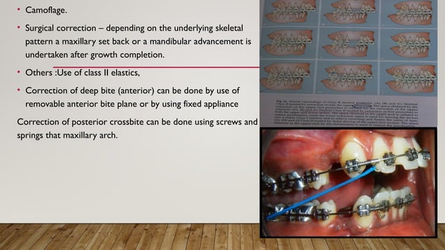 management of malocclusion in orthodontics | PPT