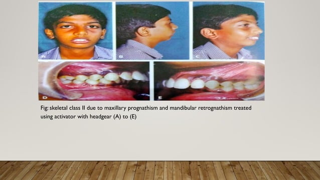 management of malocclusion in orthodontics | PPT