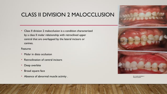 management of malocclusion in orthodontics | PPT