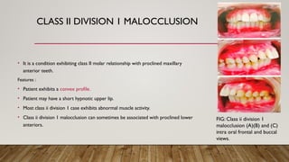 management of malocclusion in orthodontics | PPTX