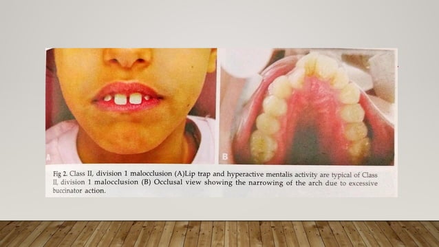 Management Of Malocclusion In Orthodontics Ppt