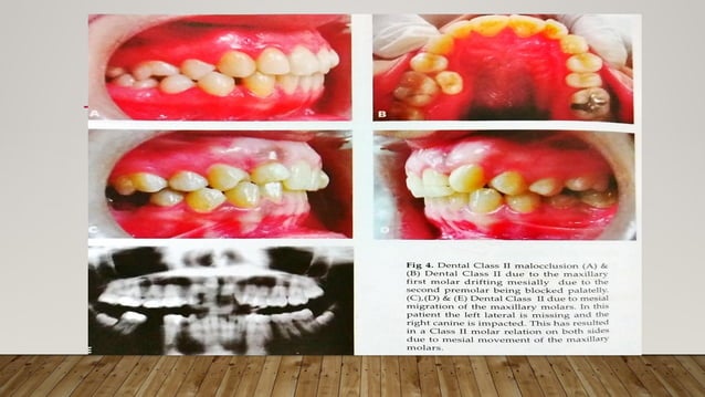 management of malocclusion in orthodontics | PPT