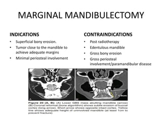 MANAGEMENT OF MANDIBLE.pptx