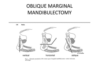 MANAGEMENT OF MANDIBLE.pptx