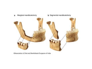 MANAGEMENT OF MANDIBLE.pptx