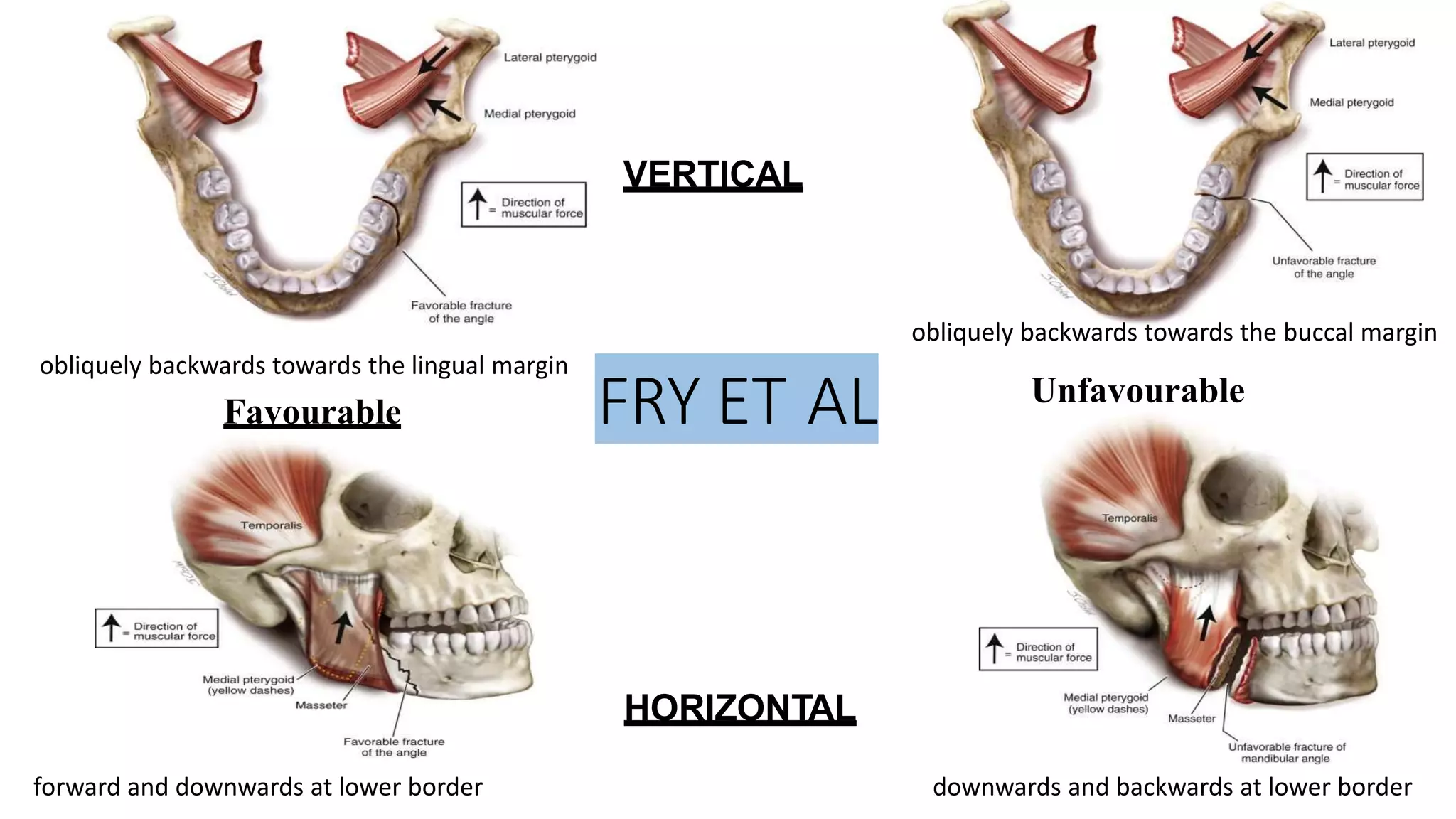MANAGEMENT OF MANDIBULAR ANGLE FRACTURE.pptx