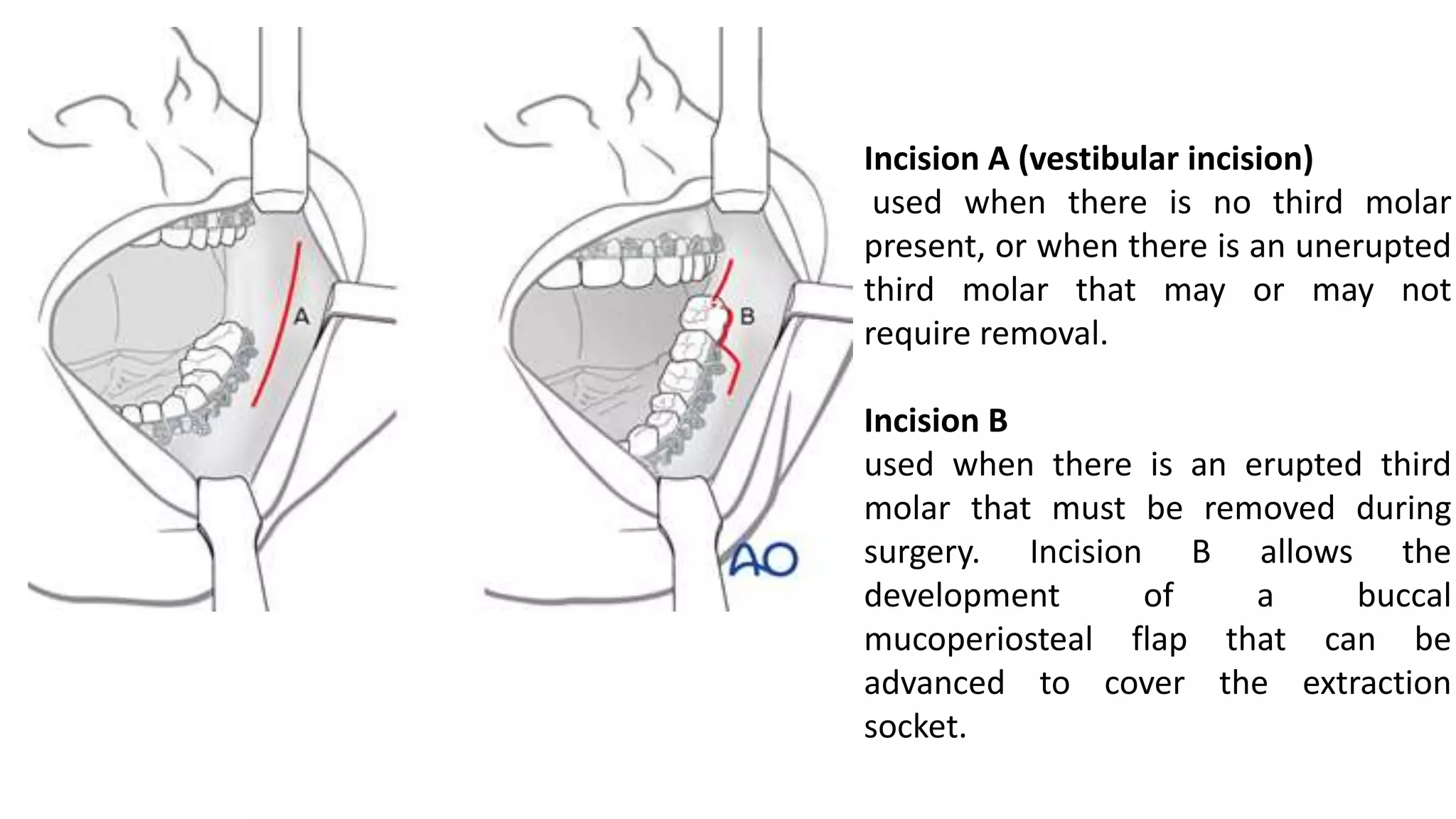 MANAGEMENT OF MANDIBULAR ANGLE FRACTURE.pptx