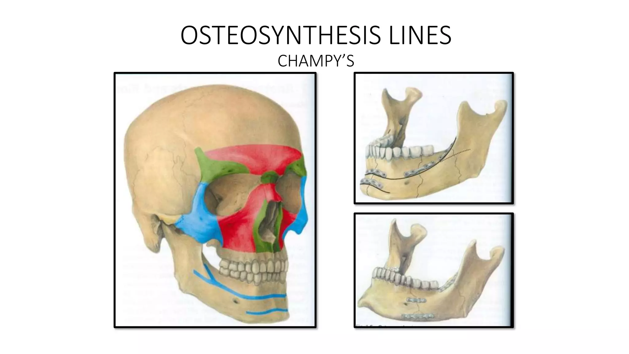 MANAGEMENT OF MANDIBULAR ANGLE FRACTURE.pptx