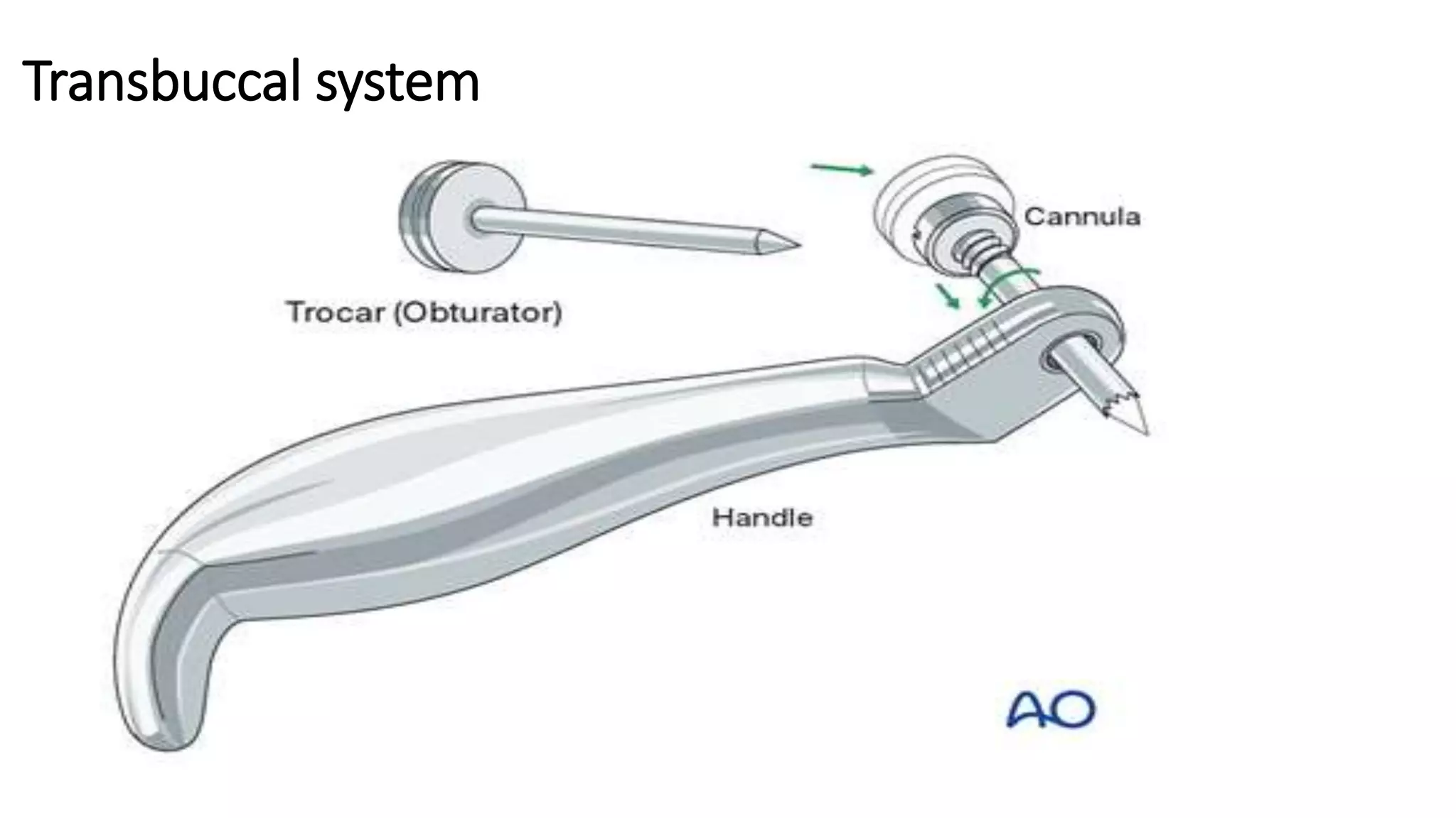 MANAGEMENT OF MANDIBULAR ANGLE FRACTURE.pptx