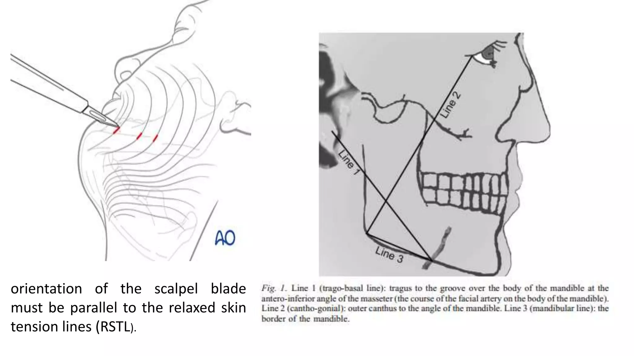 MANAGEMENT OF MANDIBULAR ANGLE FRACTURE.pptx