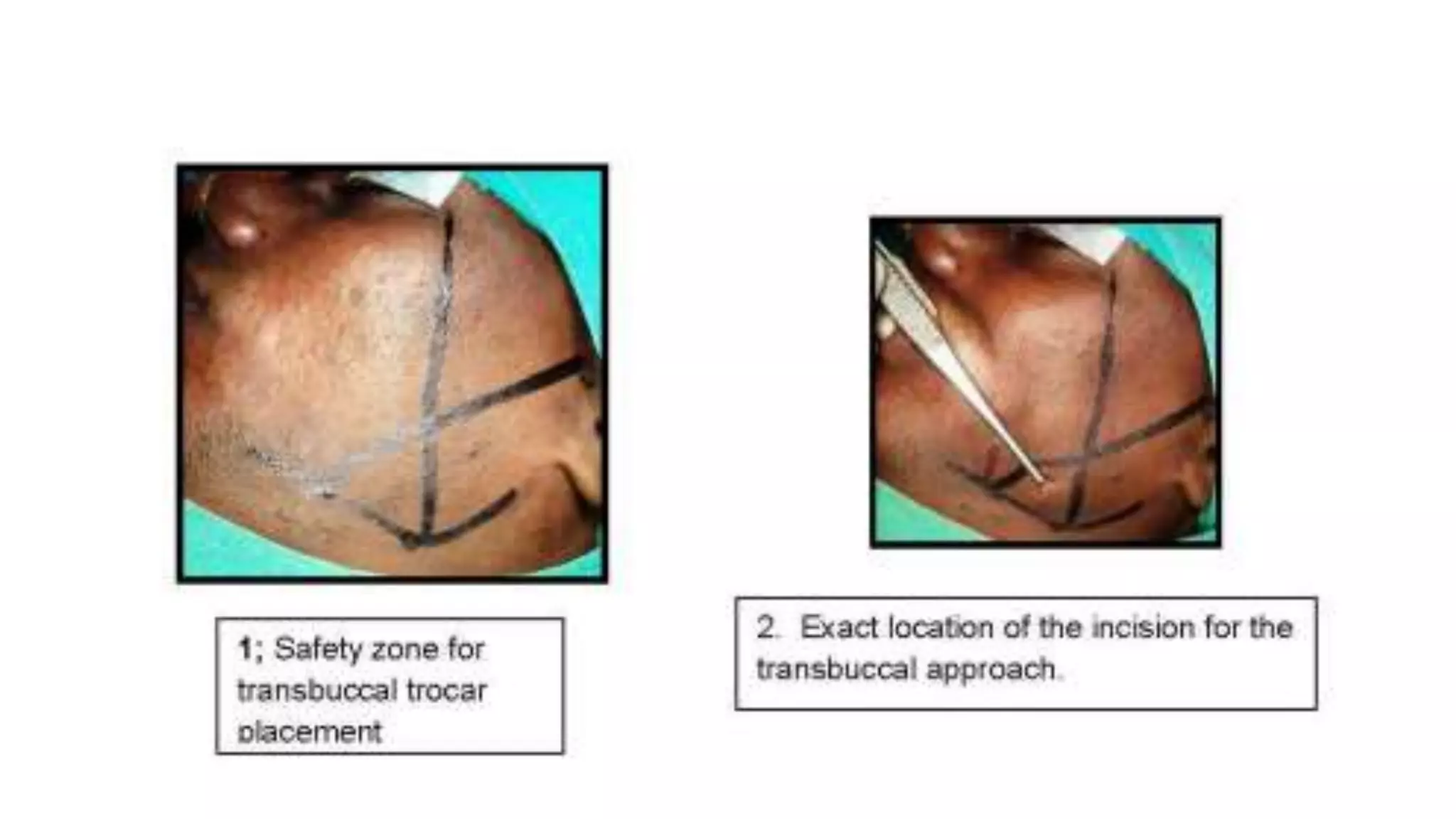 MANAGEMENT OF MANDIBULAR ANGLE FRACTURE.pptx