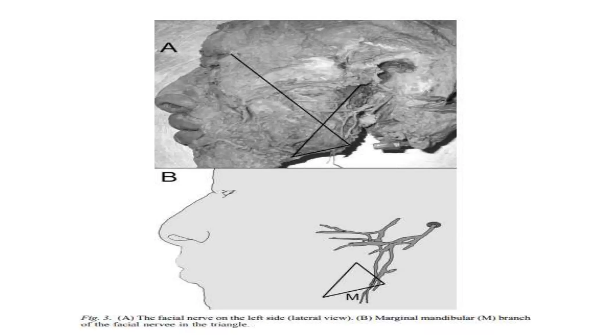 MANAGEMENT OF MANDIBULAR ANGLE FRACTURE.pptx