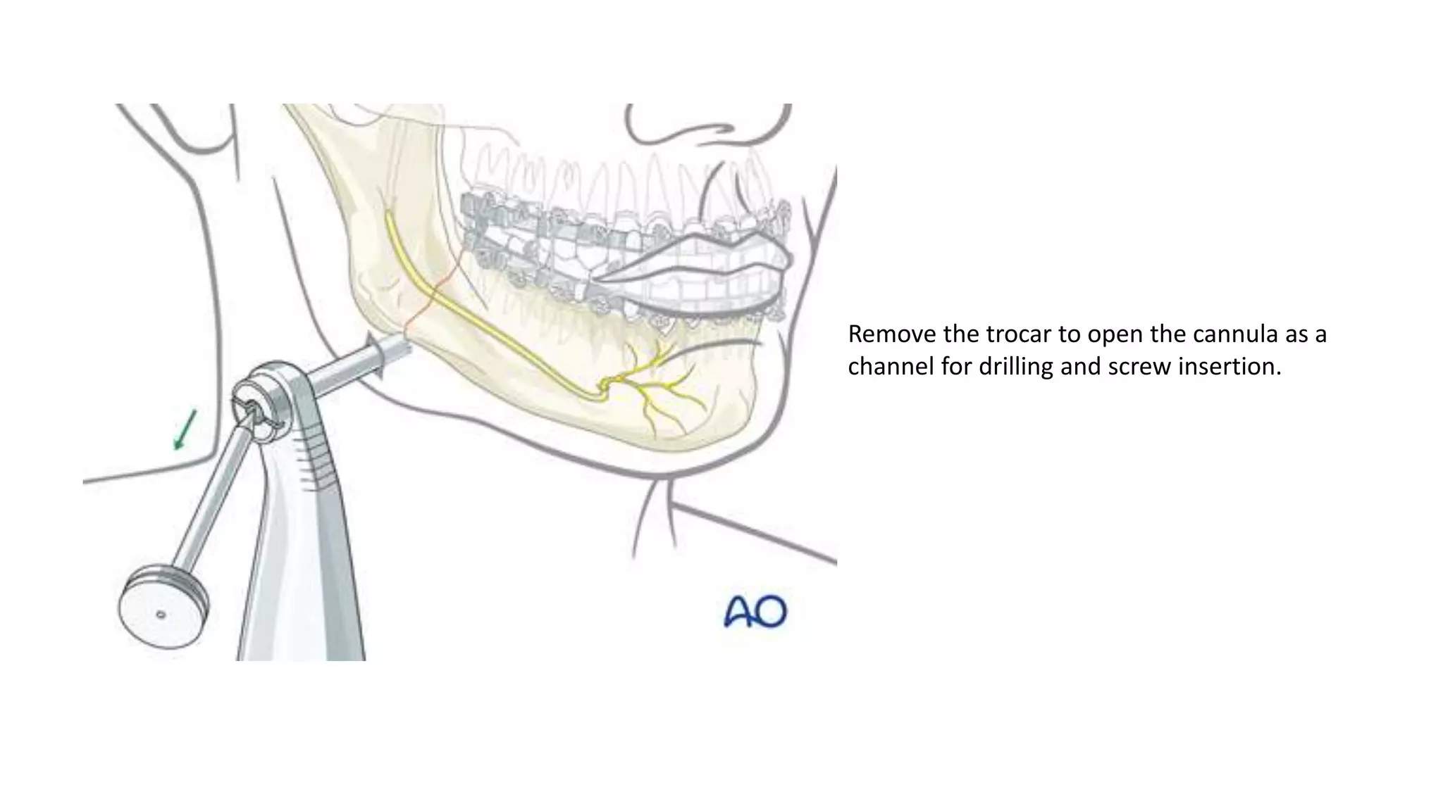 MANAGEMENT OF MANDIBULAR ANGLE FRACTURE.pptx