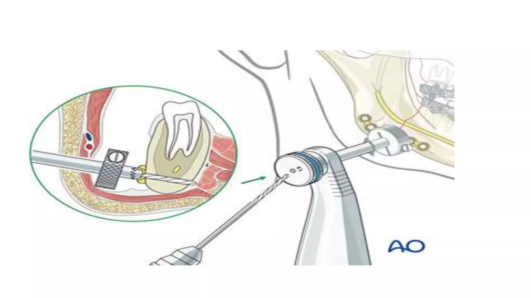 MANAGEMENT OF MANDIBULAR ANGLE FRACTURE.pptx
