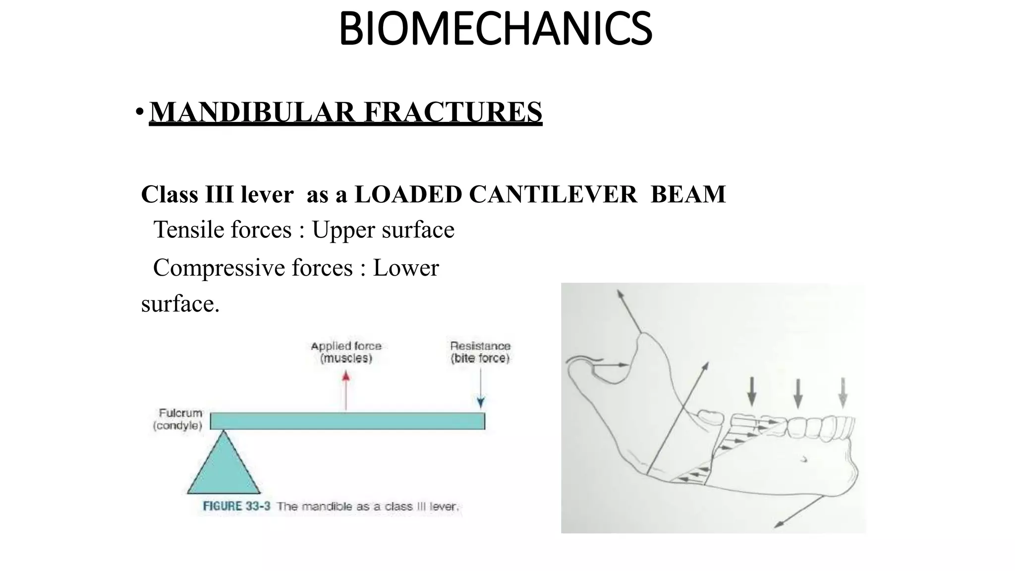 MANAGEMENT OF MANDIBULAR ANGLE FRACTURE.pptx