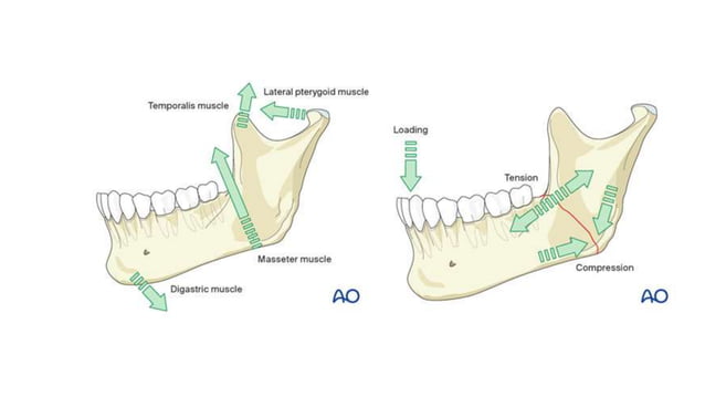 MANAGEMENT OF MANDIBULAR ANGLE FRACTURE.pptx | Dental Health | Diseases ...