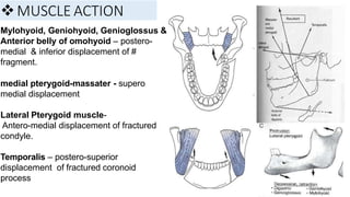 MANAGEMENT OF MANDIBULAR ANGLE FRACTURE.pptx