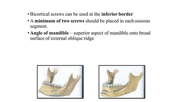 MANAGEMENT OF MANDIBULAR ANGLE FRACTURE.pptx | Dental Health | Diseases ...