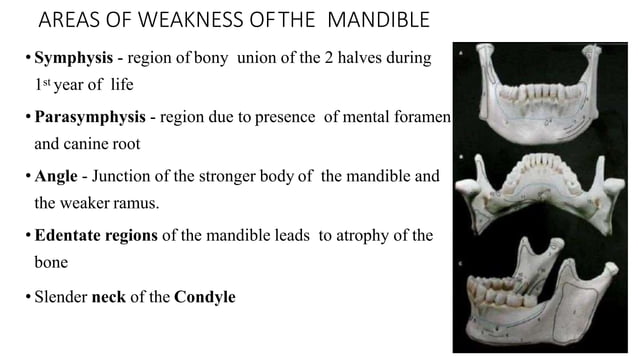 MANAGEMENT OF MANDIBULAR ANGLE FRACTURE.pptx | Dental Health | Diseases ...
