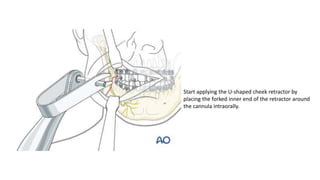 MANAGEMENT OF MANDIBULAR ANGLE FRACTURE.pptx