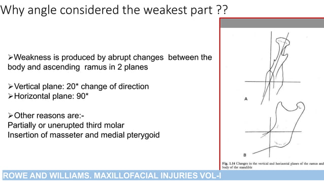 MANAGEMENT OF MANDIBULAR ANGLE FRACTURE.pptx | Dental Health | Diseases ...