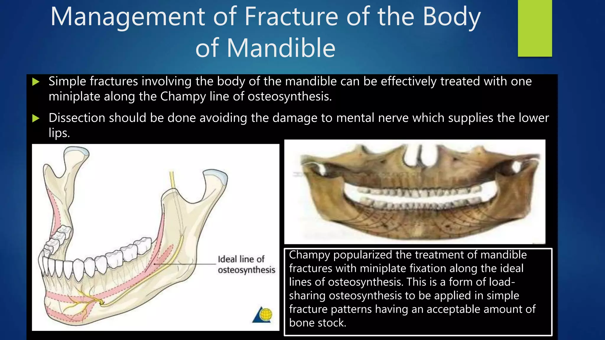 Management of Mandibular Fractures | PPTX