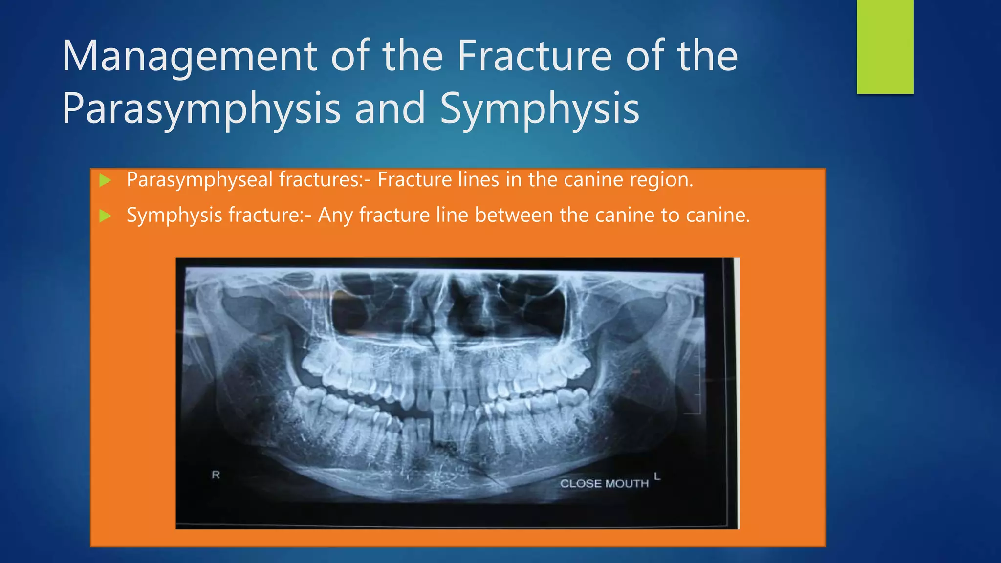 Management of Mandibular Fractures | PPTX