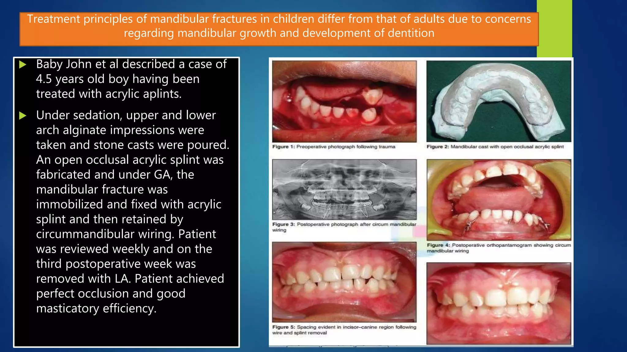 Management of Mandibular Fractures | PPTX