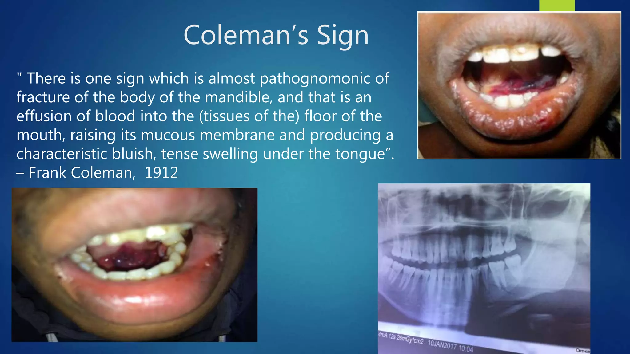 Management of Mandibular Fractures | PPTX