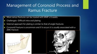Management of Mandibular Fractures | PPTX
