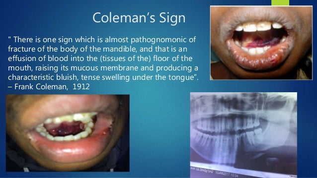 Management of Mandibular Fractures