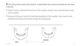 Management of Mandibular fractures.pptx