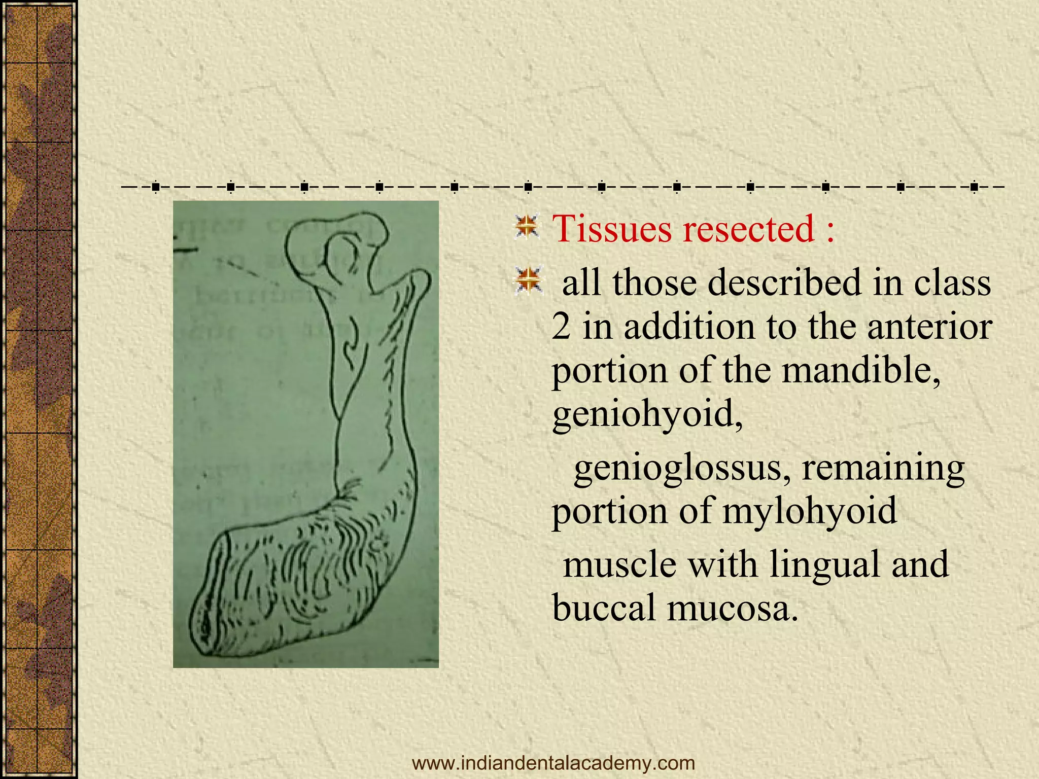 Management of mandibulectomy / /certified fixed orthodontic courses by ...
