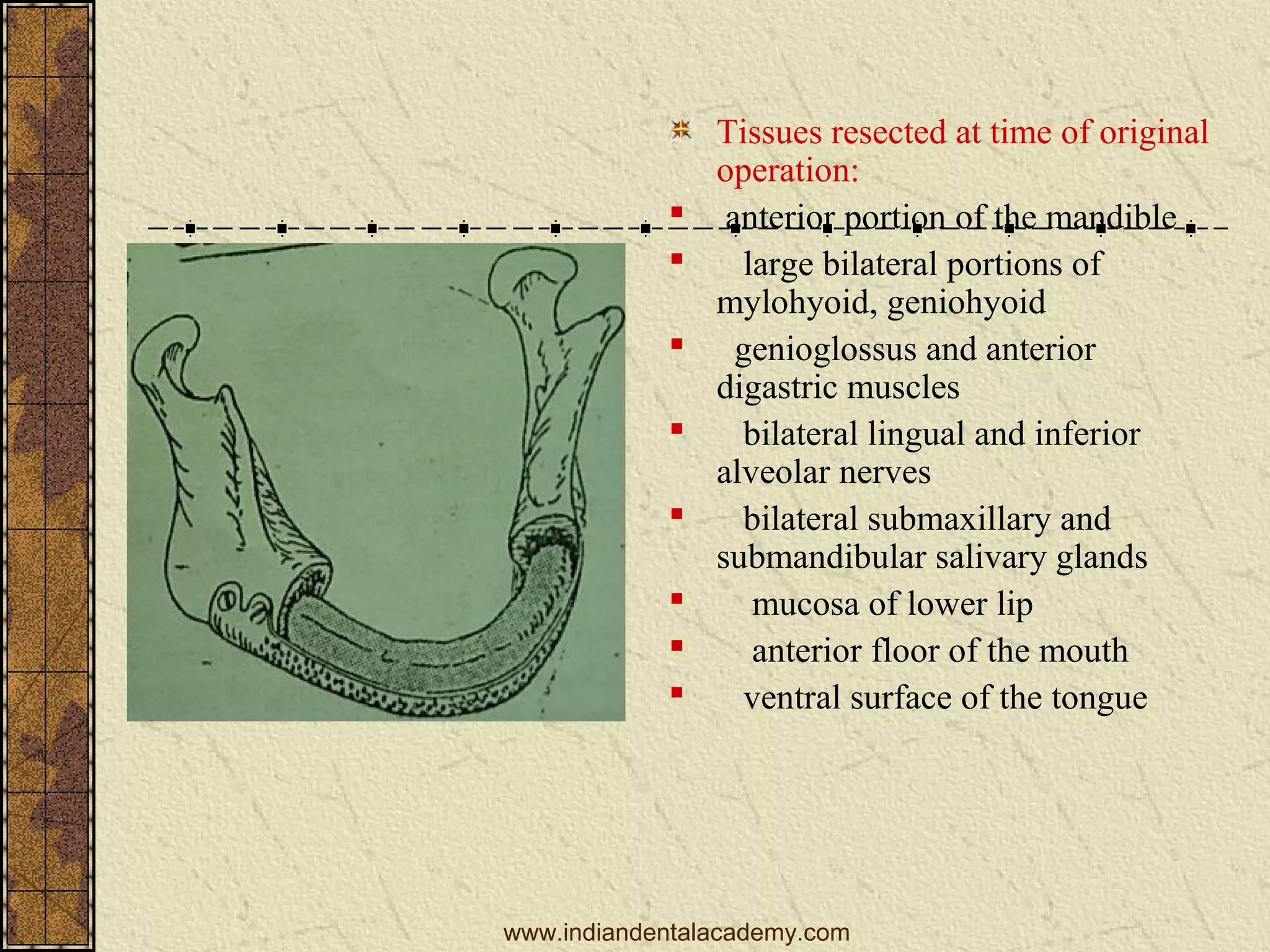 Management of mandibulectomy / /certified fixed orthodontic courses by ...