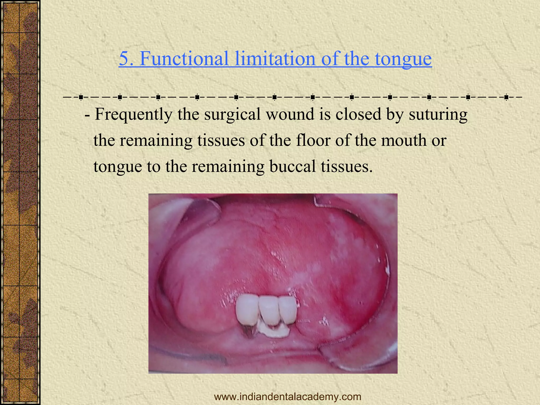 Management of mandibulectomy / /certified fixed orthodontic courses by ...