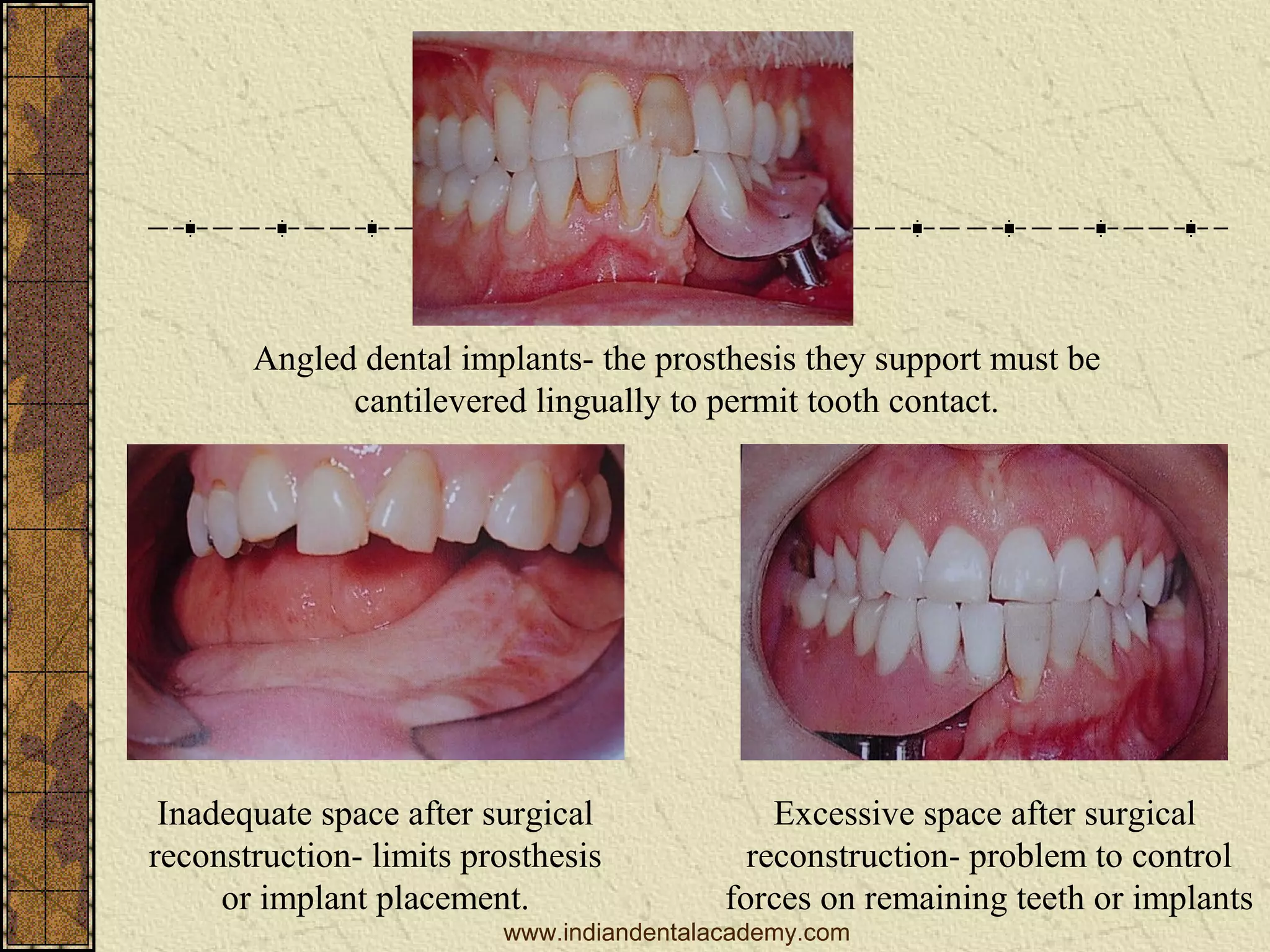Management of mandibulectomy / /certified fixed orthodontic courses by ...