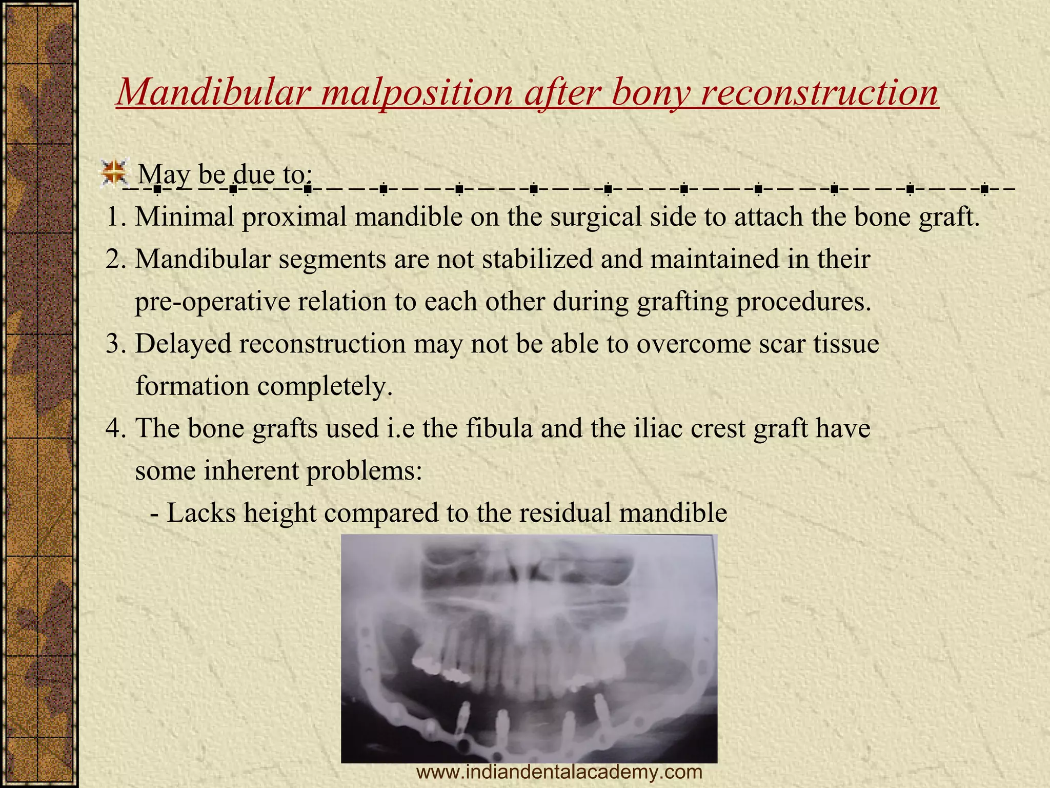 Management of mandibulectomy / /certified fixed orthodontic courses by ...