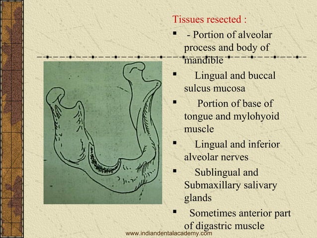 Management of mandibulectomy / /certified fixed orthodontic courses by ...