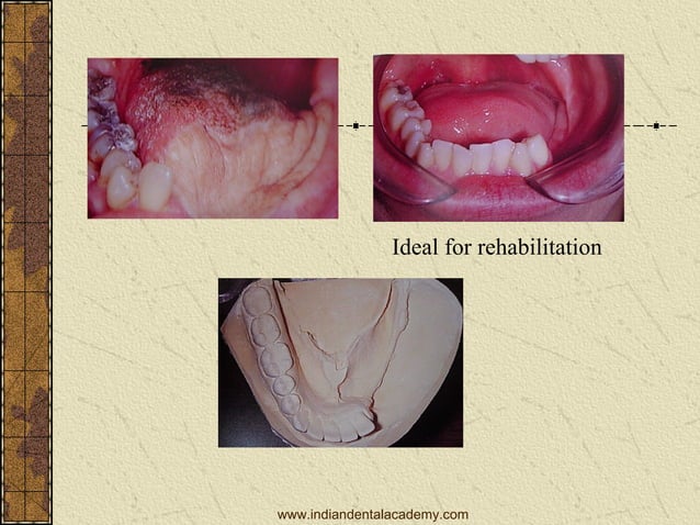 Management of mandibulectomy / /certified fixed orthodontic courses by ...