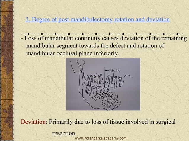Management of mandibulectomy / /certified fixed orthodontic courses by ...
