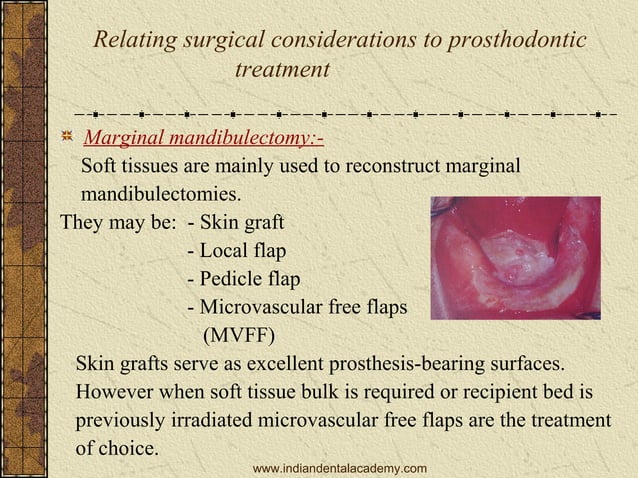 Management of mandibulectomy / /certified fixed orthodontic courses by ...