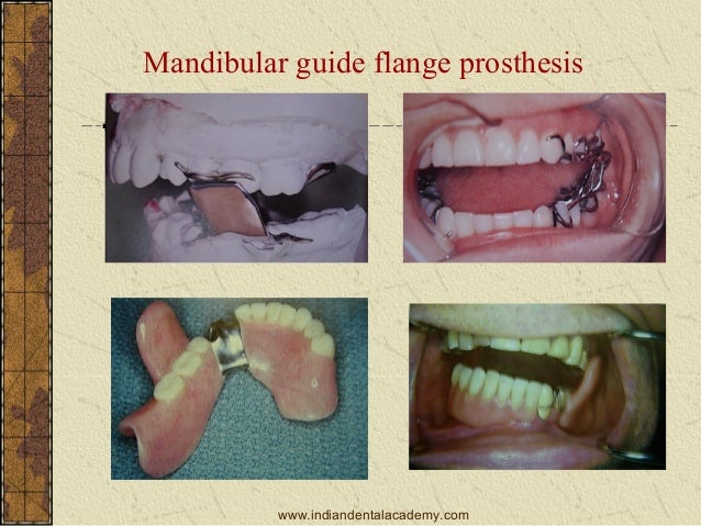 Management of mandibulectomy / /certified fixed orthodontic courses b…