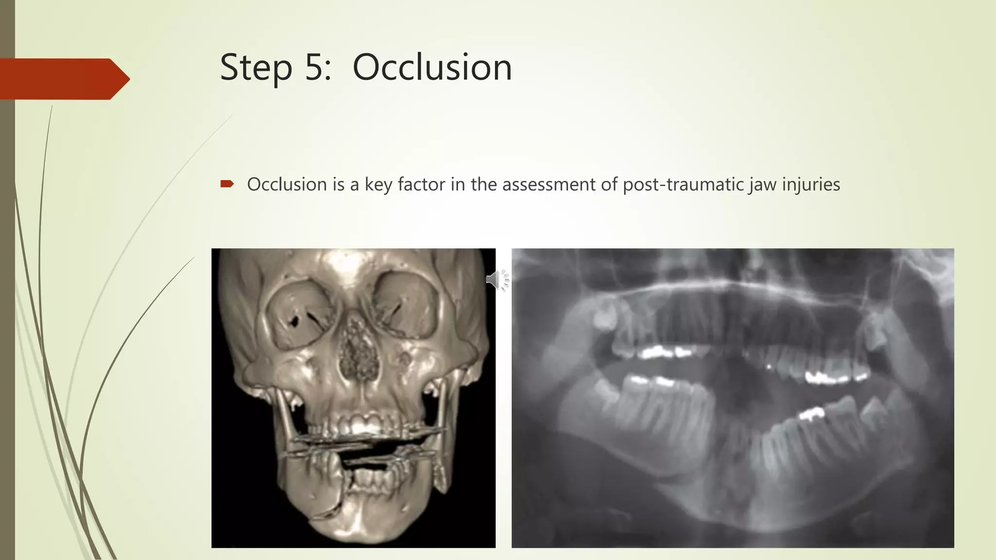 Management of maxillofacial trauma | PPTX