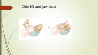Management of maxillofacial trauma | PPTX