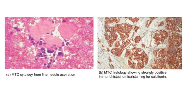 Management of Medullary Thyroid Cancer/anaplastic thyroid cancer ...