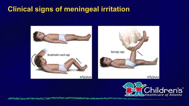 Management of meningeal signs in children | PPTX | Brain and Nervous ...
