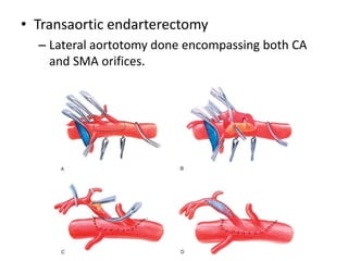 Management of mesenteric vascular occlusion | PPTX